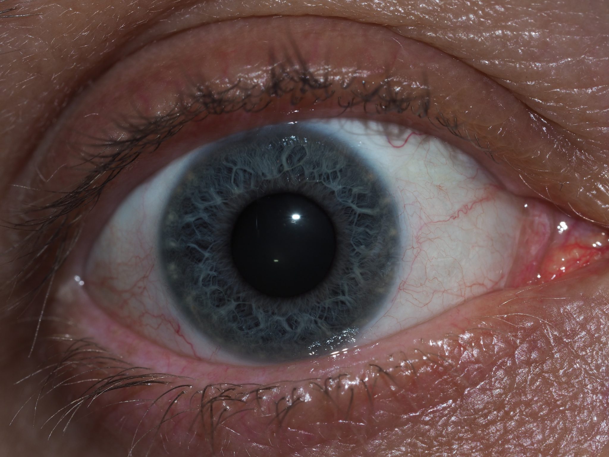 Pterygium - Dr Tom Cunneen - Eye Surgery Perth