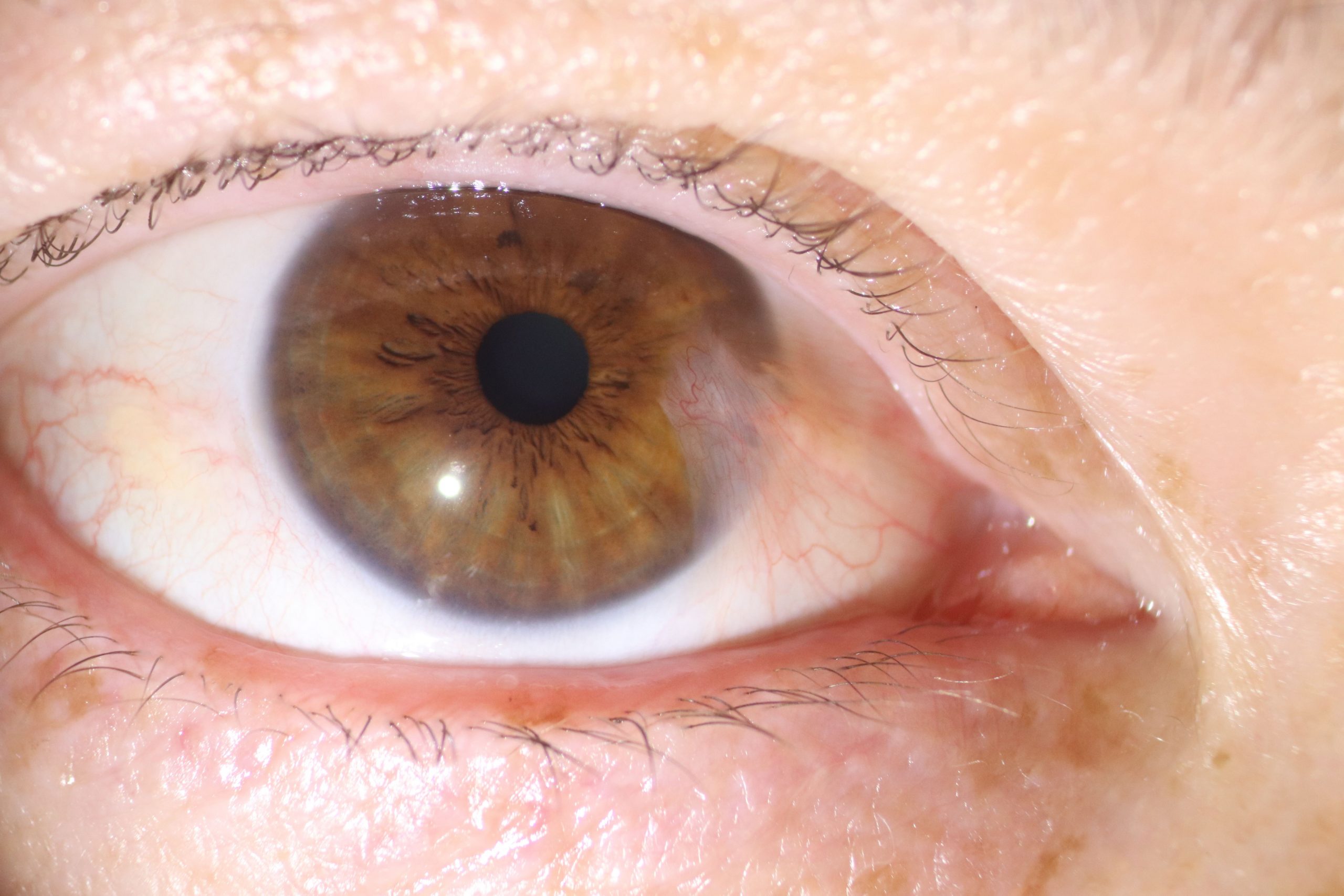 Pterygium Dr Tom Cunneen Eye Surgery Perth