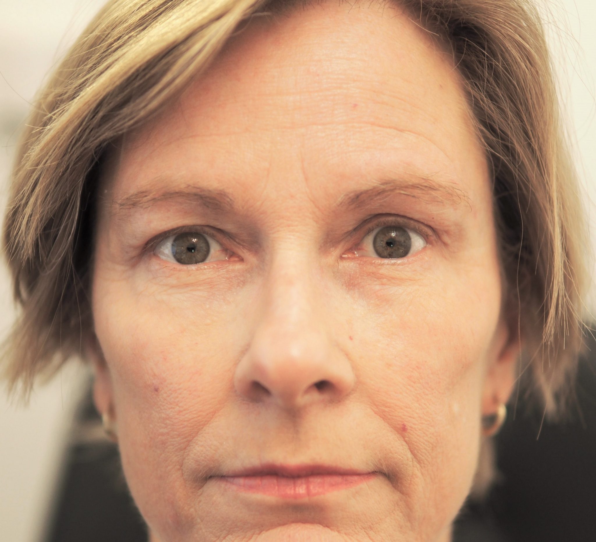 Eyelid surgery - Dr Tom Cunneen - Eye Surgery Perth