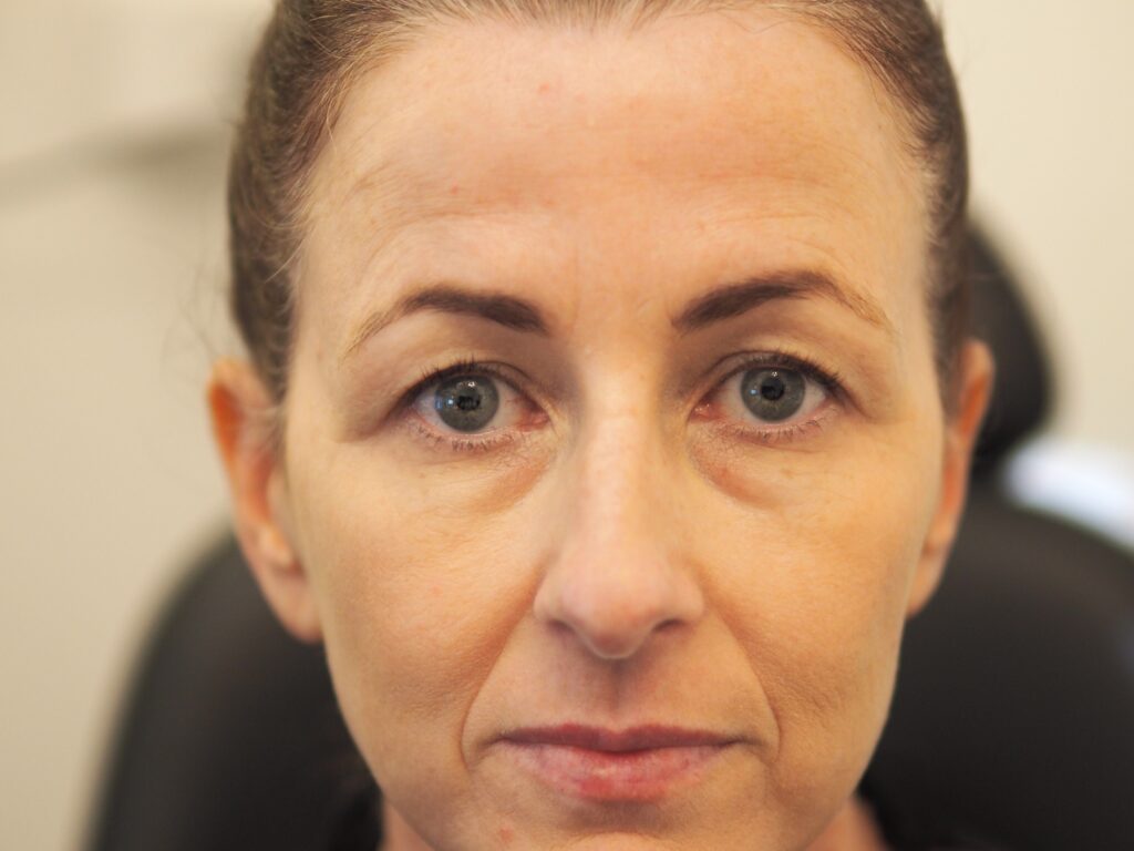 Eyelid surgery - Dr Tom Cunneen - Eye Surgery Perth