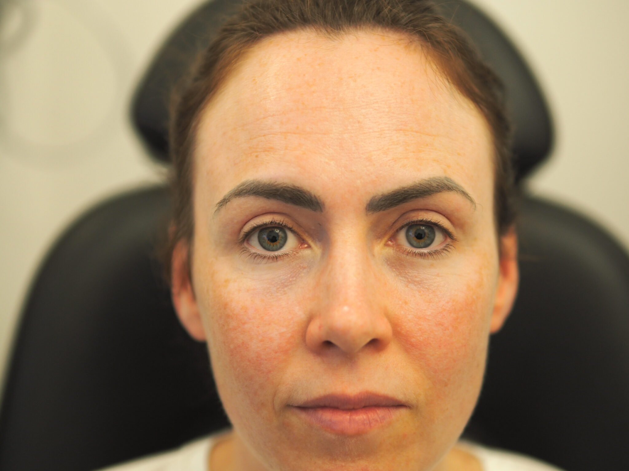 Eyelid surgery - Dr Tom Cunneen - Eye Surgery Perth
