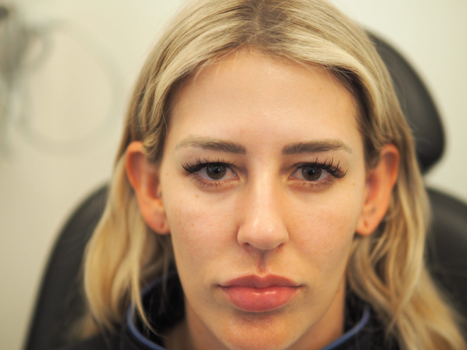 Eyelid surgery - Dr Tom Cunneen - Eye Surgery Perth